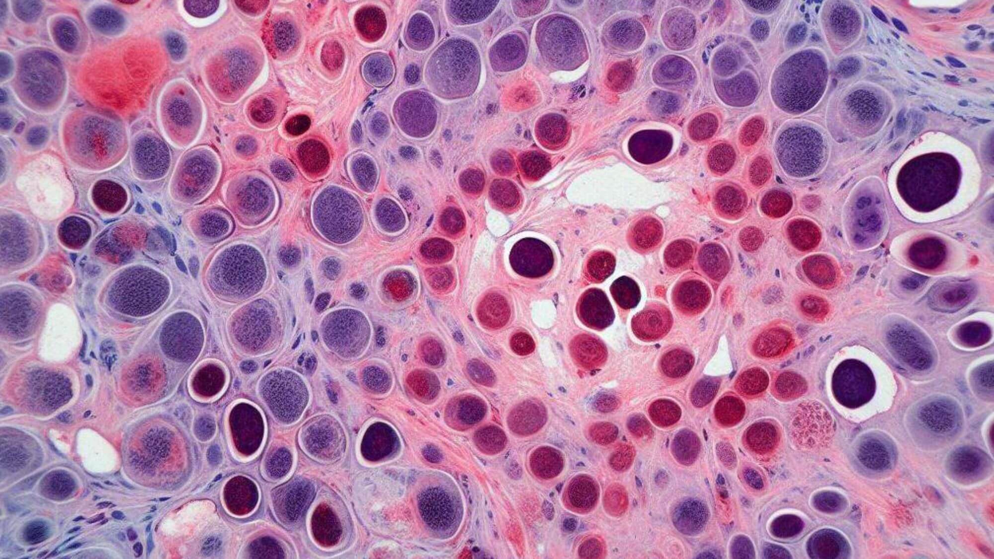 New company tricks cancer cells into self-destructing - Stanford University